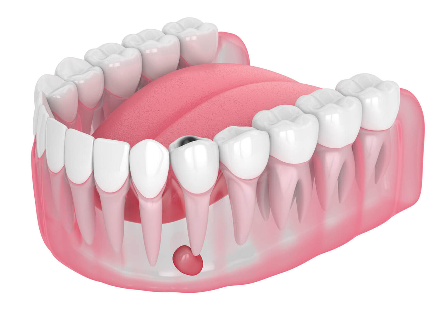 Recognizing and Receiving Emergency Dentistry for Gum Abscesses ...
