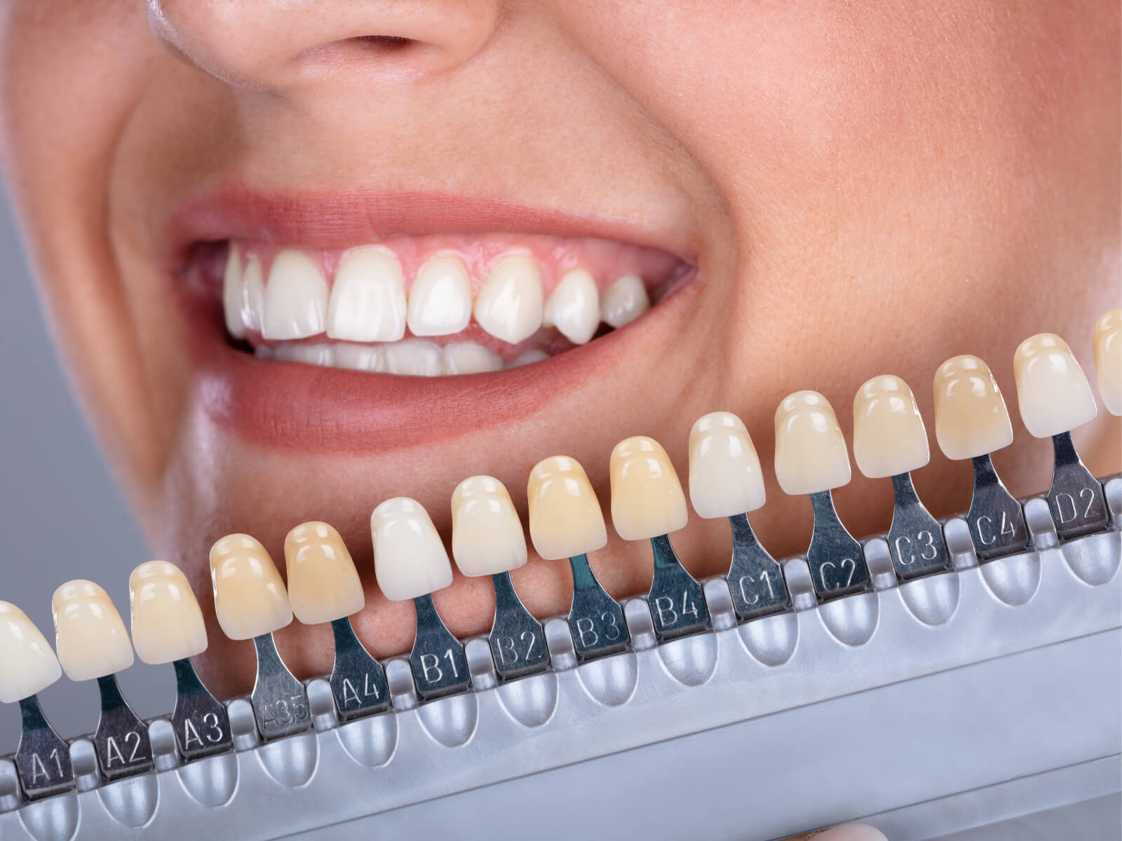 Key Tips for Better Before and After Teeth Whitening
